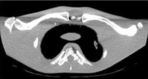 CT Artifacts | OncologyMedicalPhysics.com