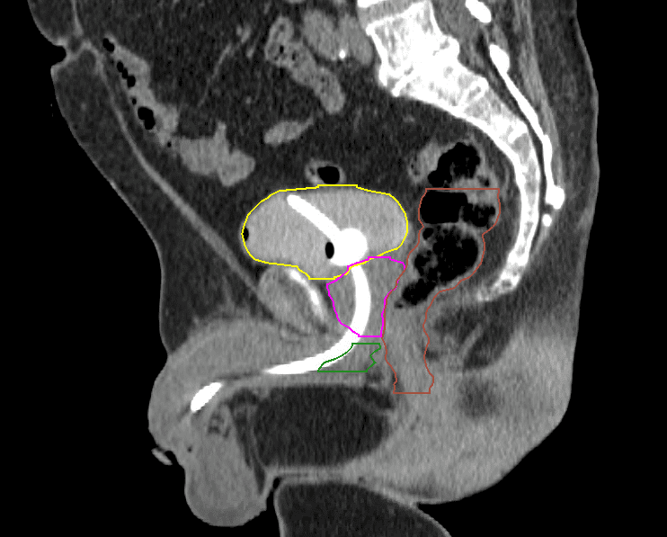 Bladder, prostate, bulb, rectum – Oncology Medical Physics