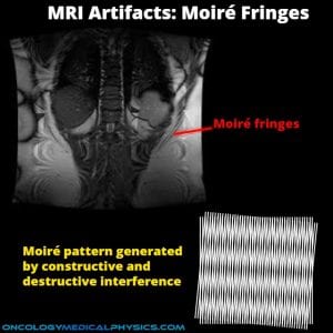 MRI Artifacts | Oncology Medical Physics