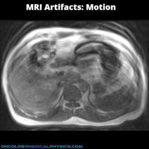 MRI Artifacts | OncologyMedicalPhysics.com