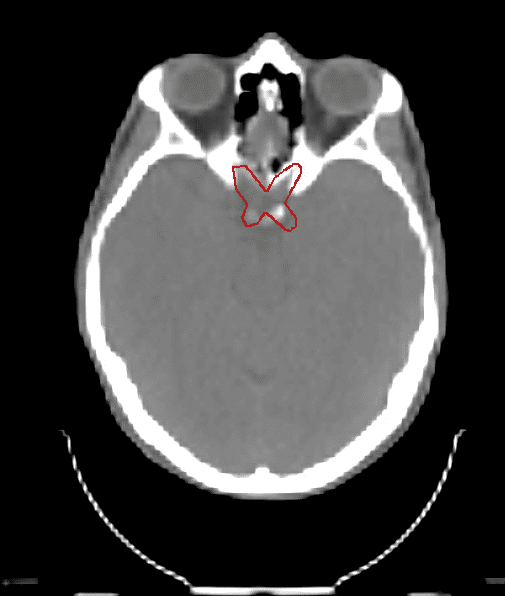 chiasm – Oncology Medical Physics