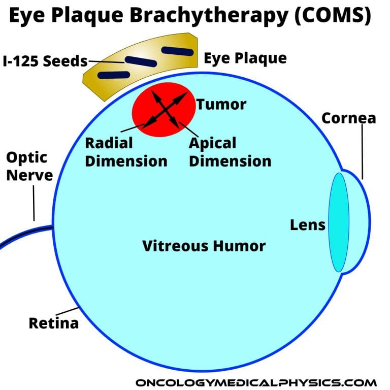 Ocular Brachytherapy | Oncology Medical Physics