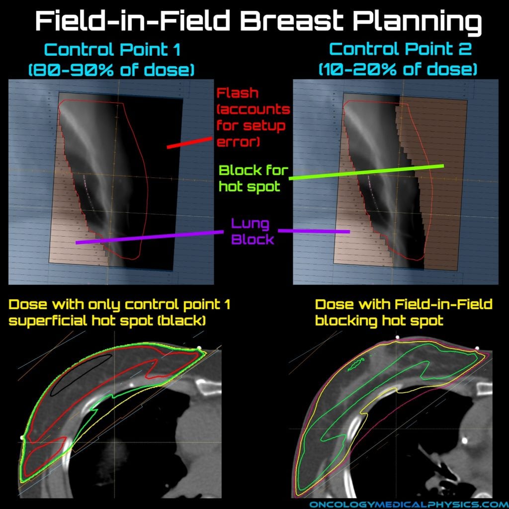 Basic Photon Treatment Planning | Oncology Medical Physics