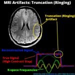 MRI Artifacts | Oncology Medical Physics