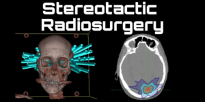 Stereotactic Body Radiotherapy | Oncology Medical Physics